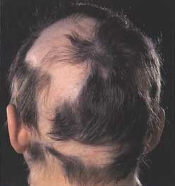 Mind-Body Methods for Alopecia Areata | Psychology Today