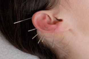 Hold that needle: Acupuncture for holistic addiction treatment ...