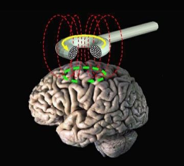 Brain Networks in TMS for Combined PTSD and Major Depression ...
