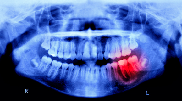 6 Ways Stress Affects Your Teeth and Gums | Psychology Today UK