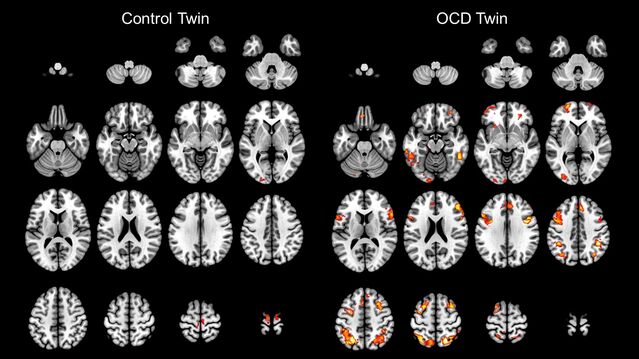 mri scan ocd