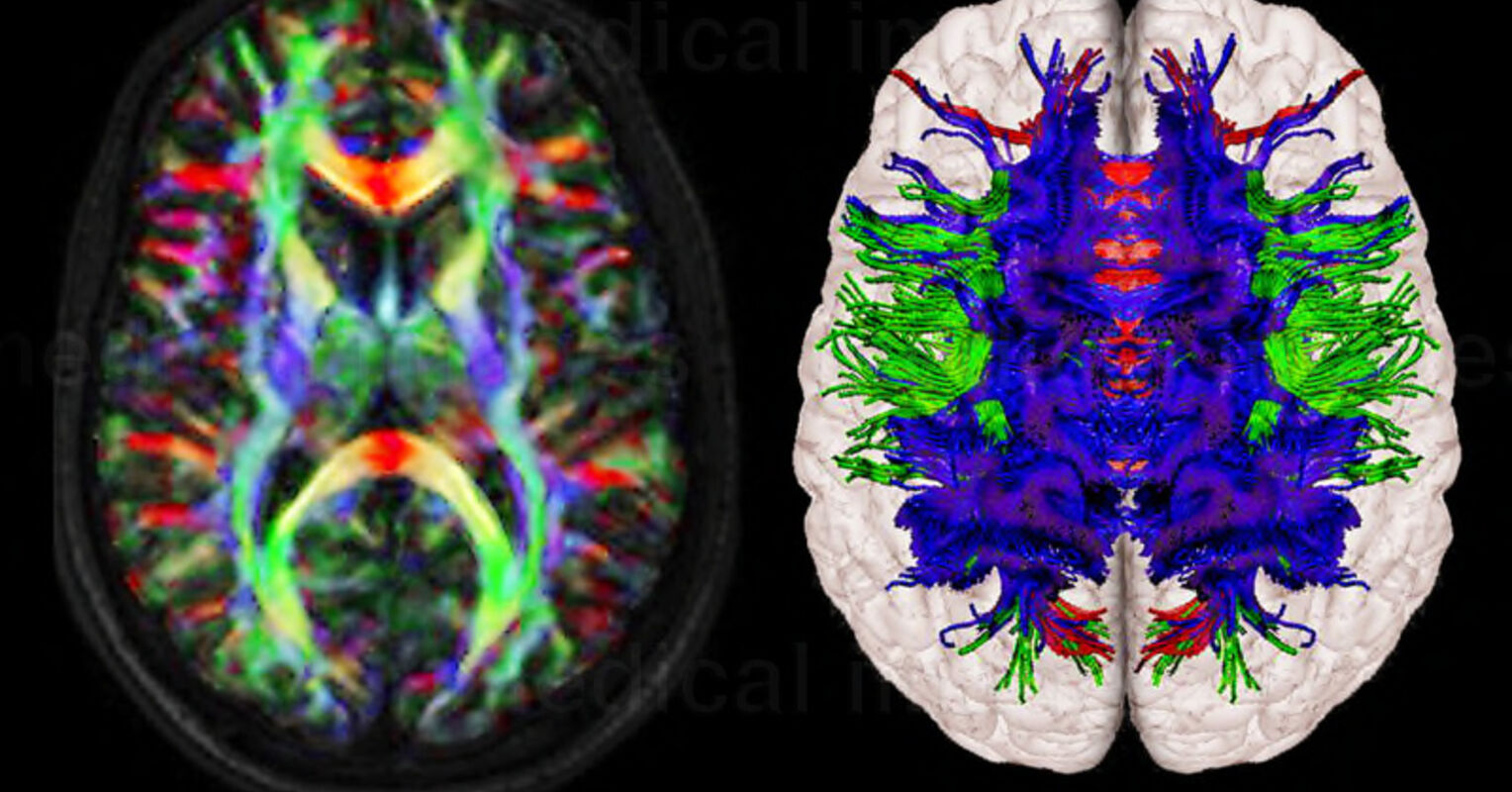 Why White Matter Matters: Diffusion Tensor Imaging | Psychology Today