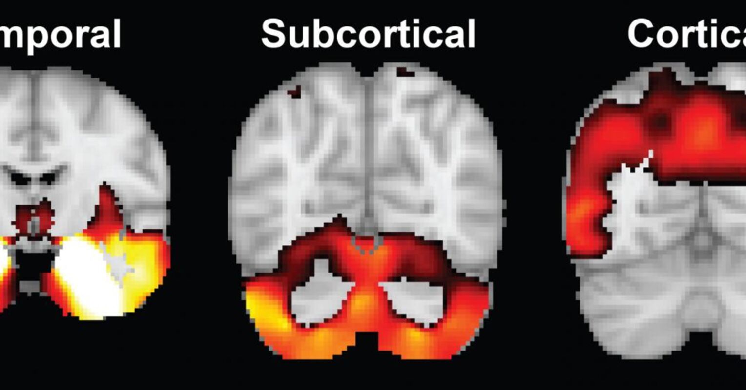 Alzheimer's Study Links Triad of Brain Areas with Cognition ...